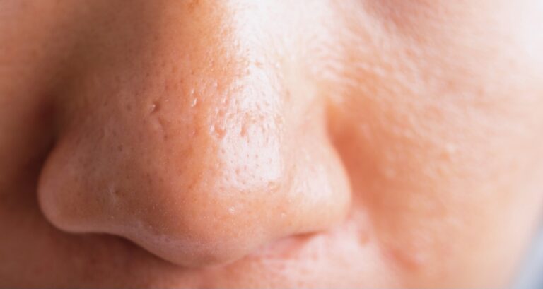 Get Rid of Large Pores Using Laser Treatments | Aeon Medical